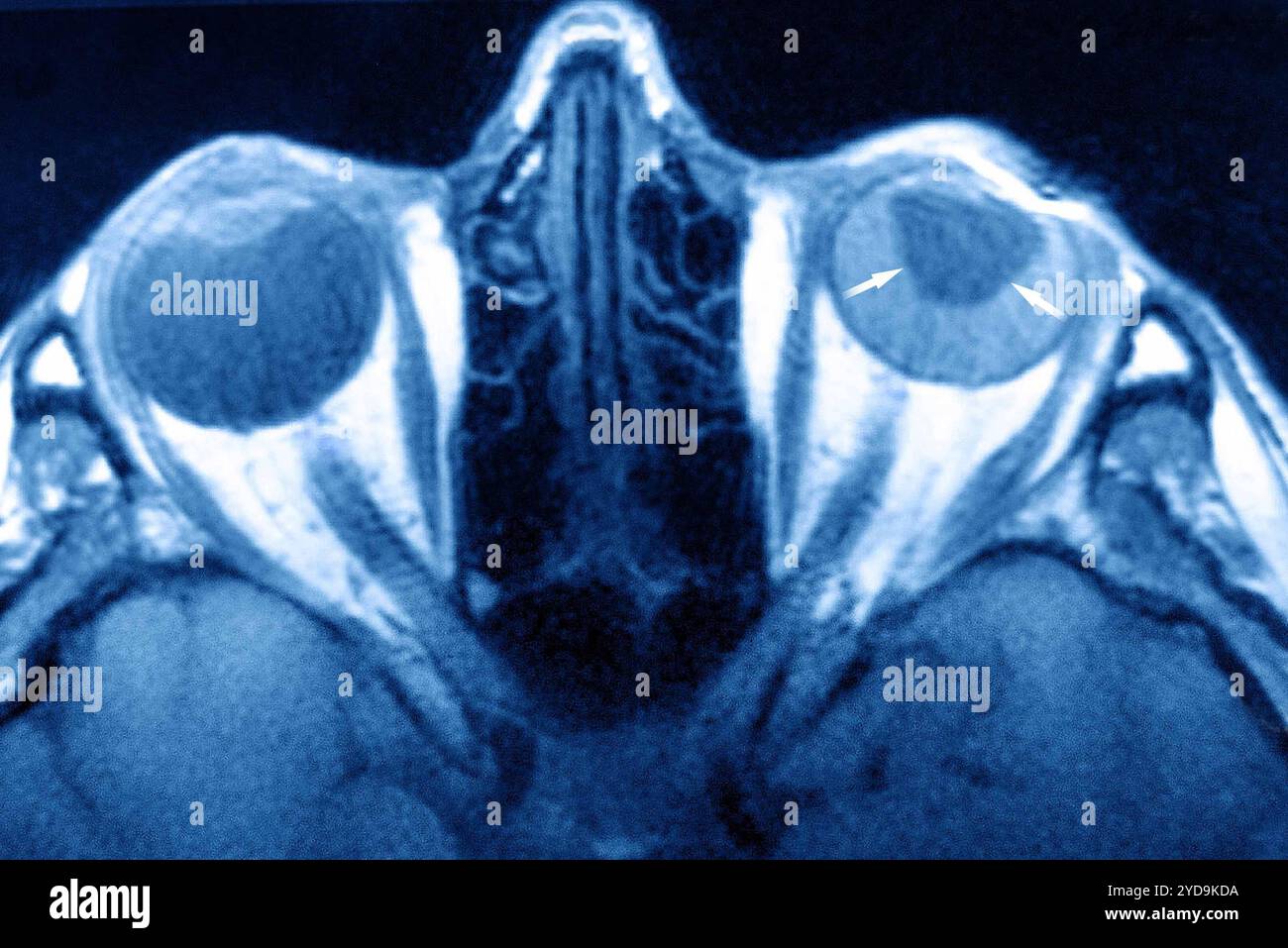 Retinal detachment occurs when the tissue at the back of the eye ...