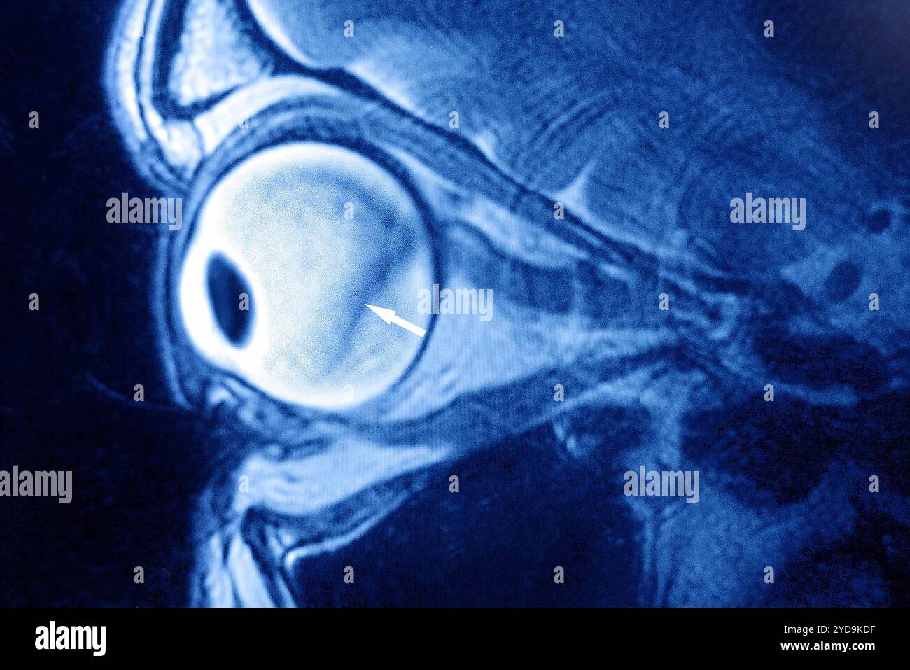Retinal detachment occurs when the tissue at the back of the eye ...