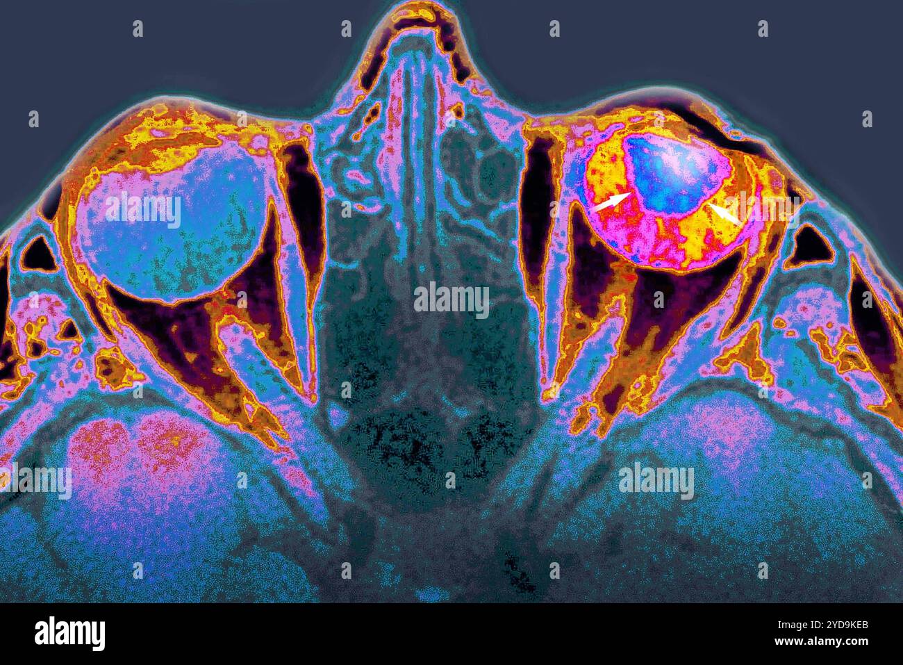 Retinal detachment occurs when the tissue at the back of the eye ...