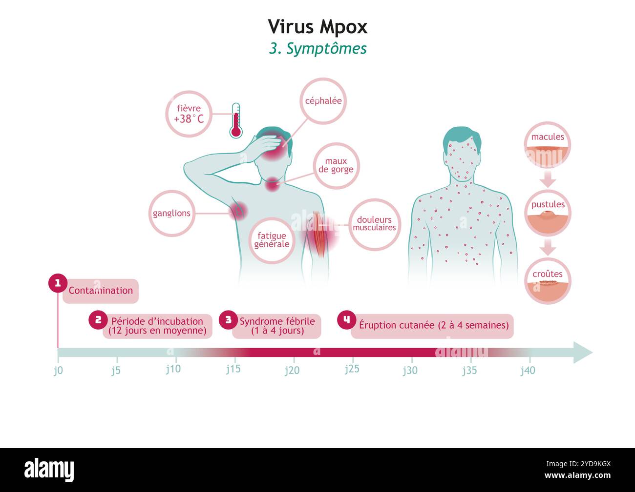 Symptoms of Mpox virus. Mpox 016878 007 Stock Photo - Alamy