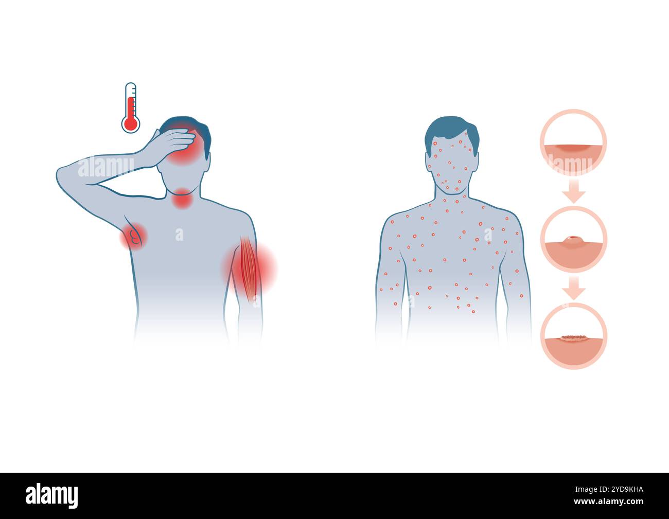 Mpox virus hi-res stock photography and images - Alamy