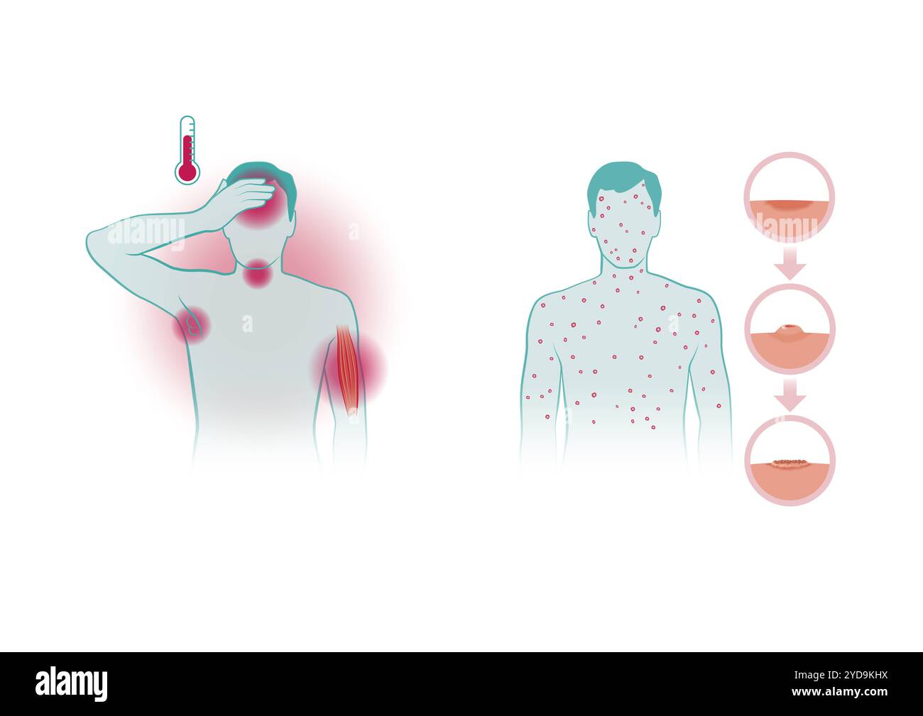 Symptoms of Mpox virus. Mpox 016878 015 Stock Photo - Alamy