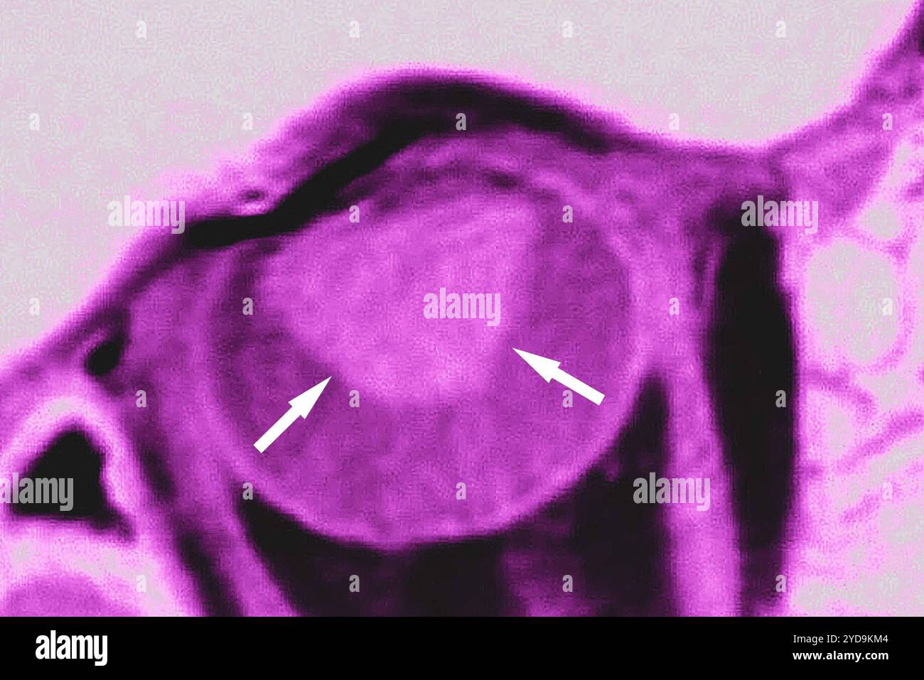 Retinal detachment occurs when the tissue at the back of the eye ...