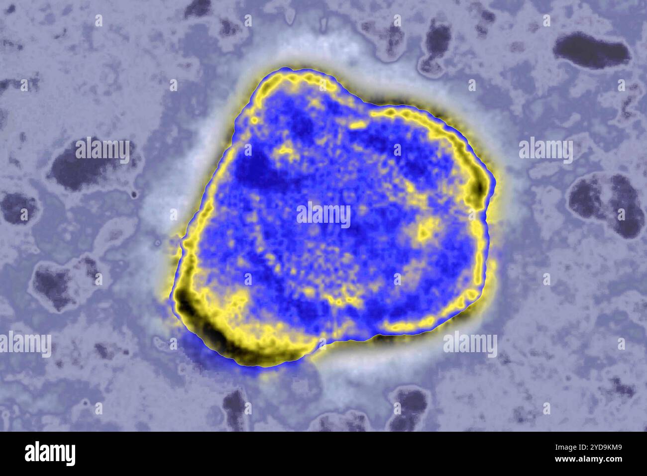 Herpes virus HSV. HSV is the cause of cold sores, genital herpes ...