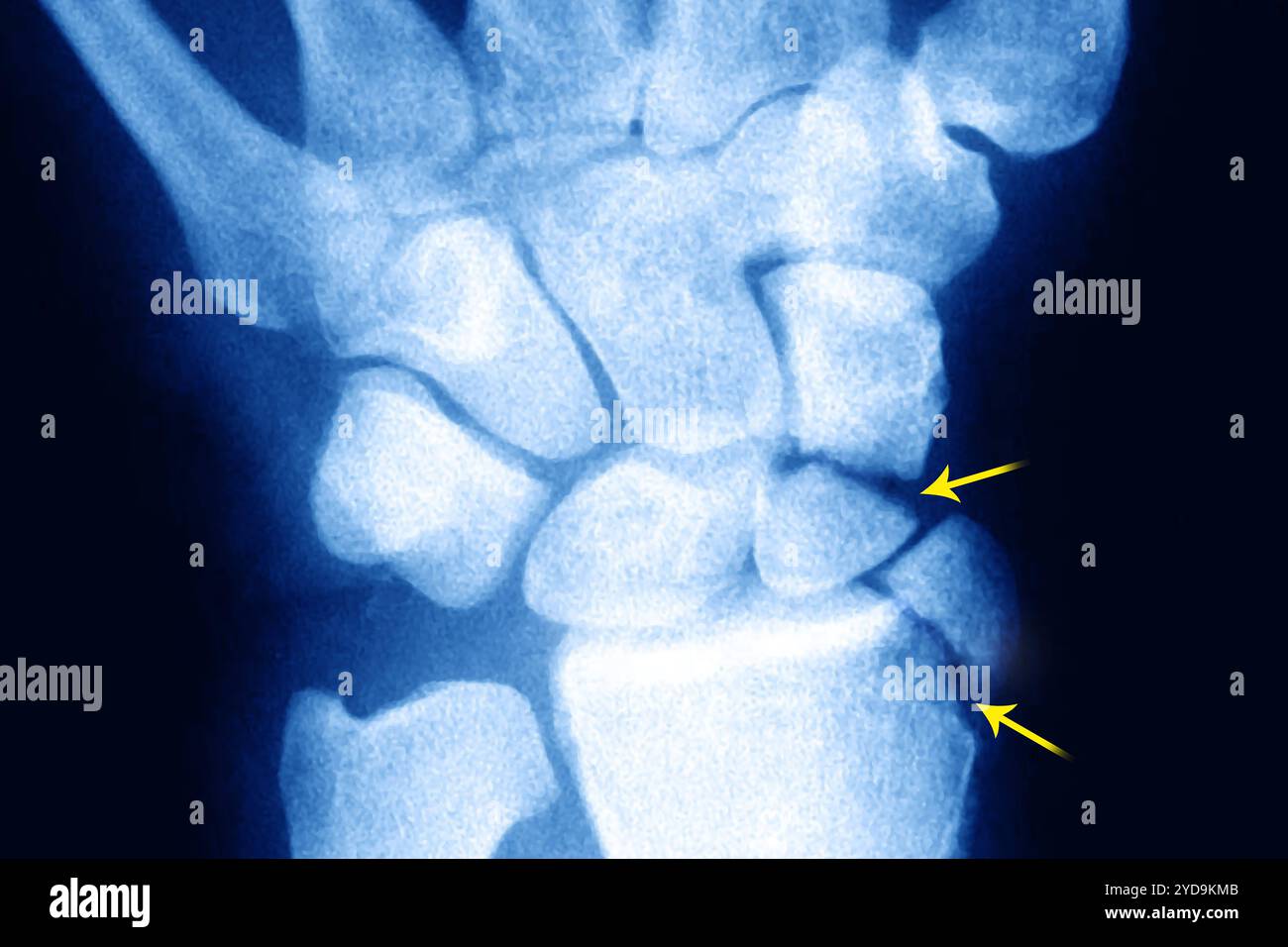 Wrist fracture scaphoid and radius. X-ray of the wrist of a right hand ...