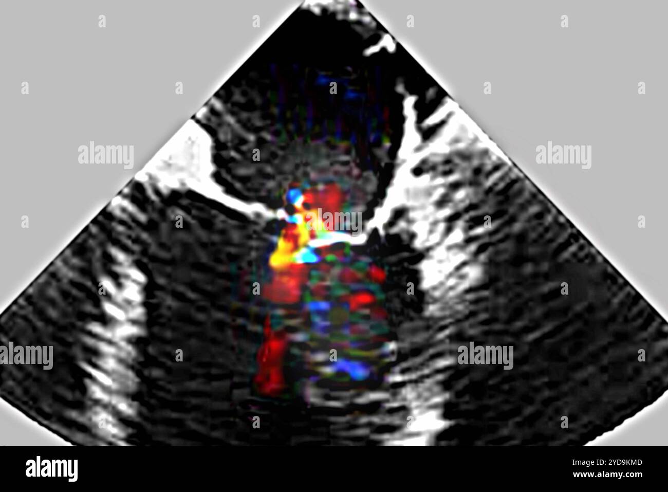 Ischemic Mitral Insufficiency Mi Pathology Of The Left Ventricle