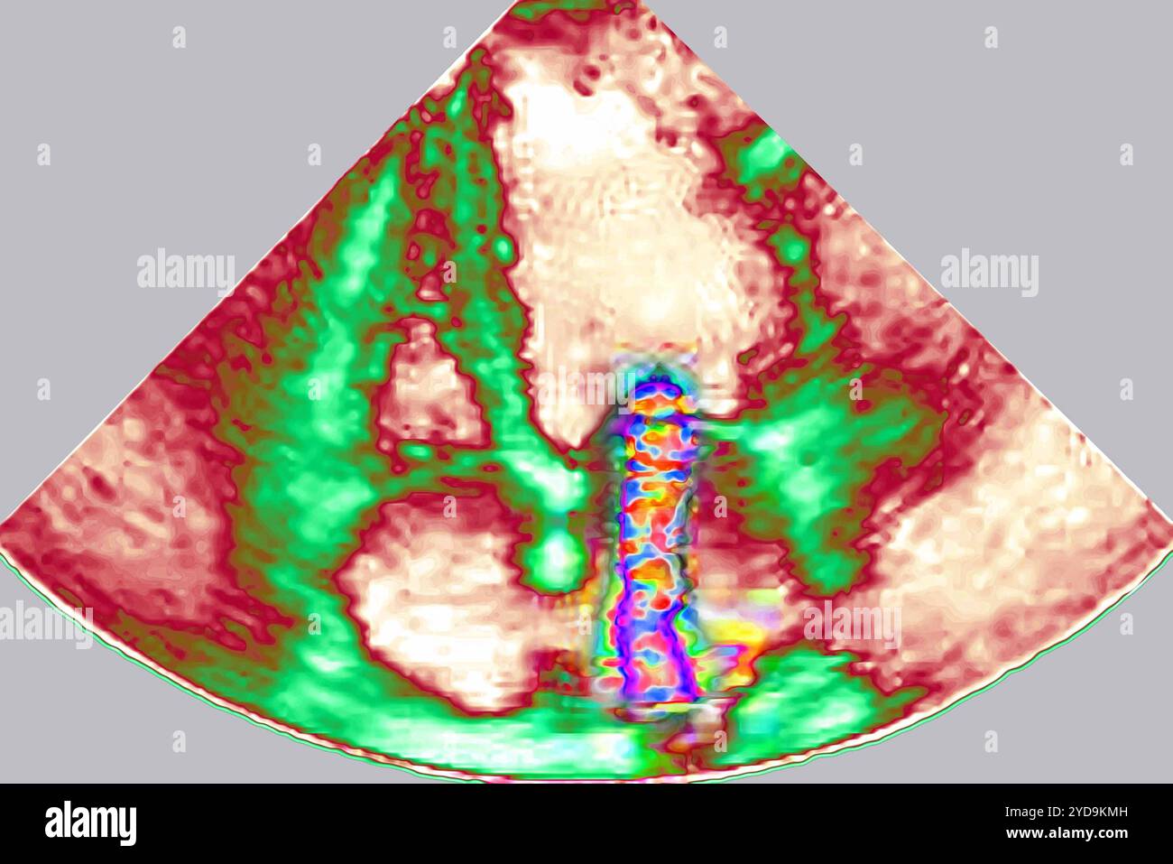 Ischemic Mitral Insufficiency Mi Pathology Of The Left Ventricle