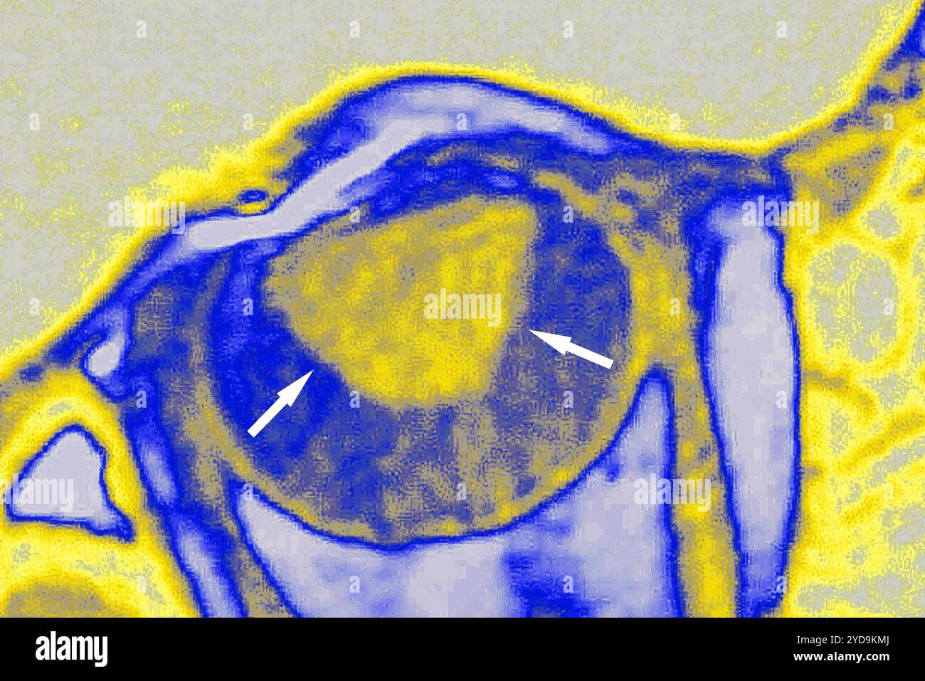 Retinal detachment occurs when the tissue at the back of the eye ...