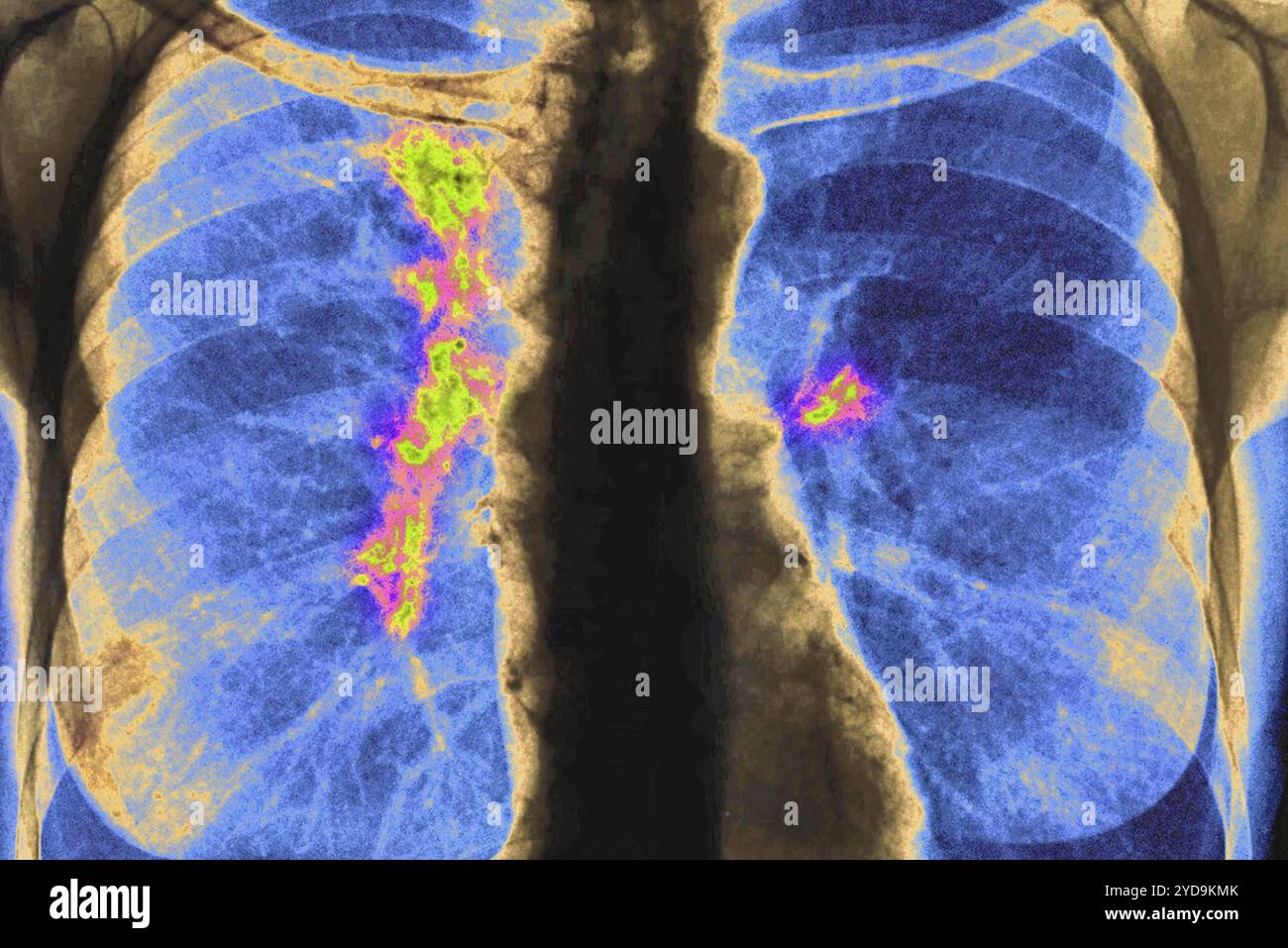 Right and left lung cancer stage 1. Front chest x-ray. Lung cancer ...