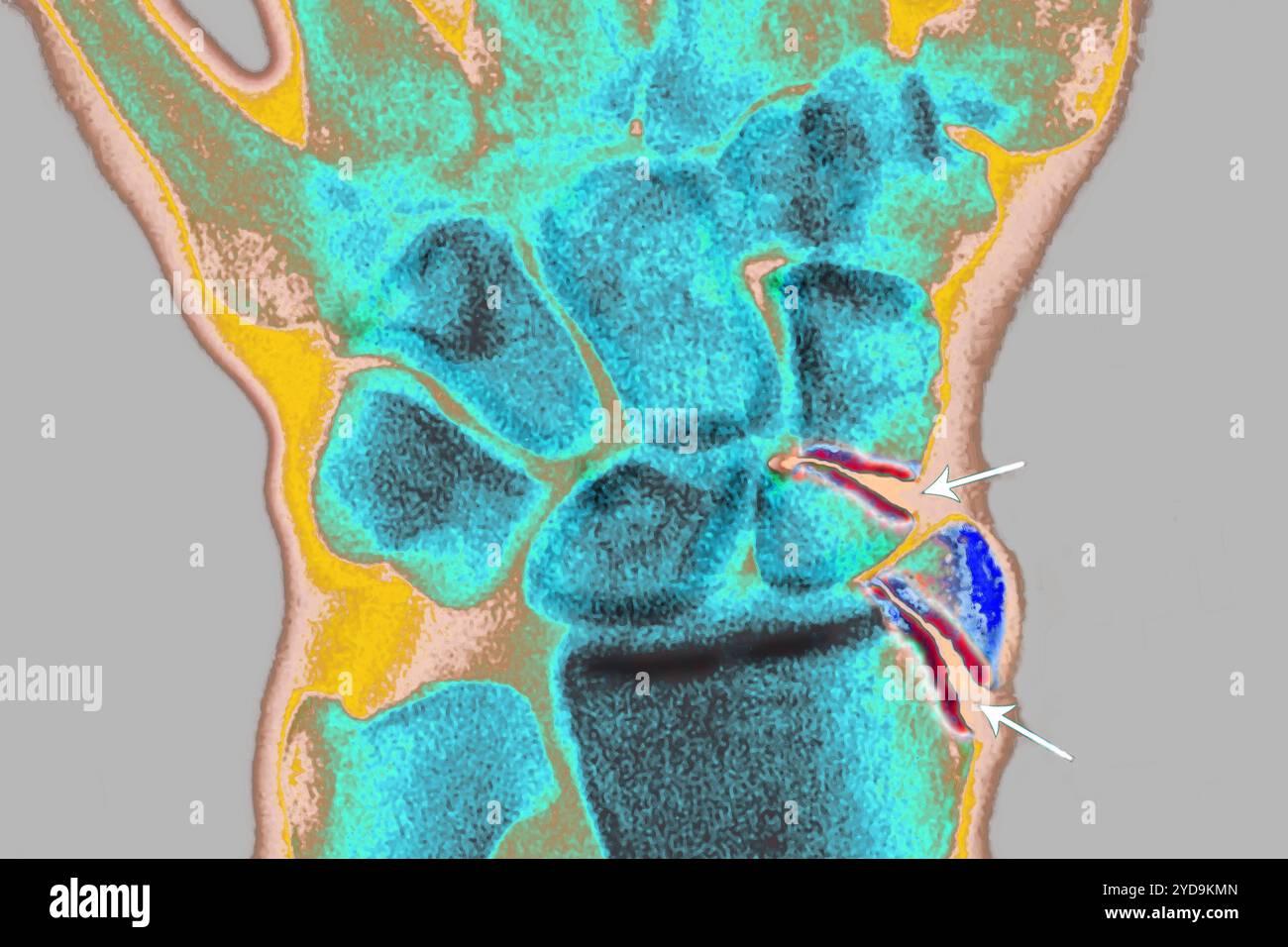 Wrist fracture scaphoid and radius. X-ray of the wrist of a right hand. Wrist fracture 016836 ...