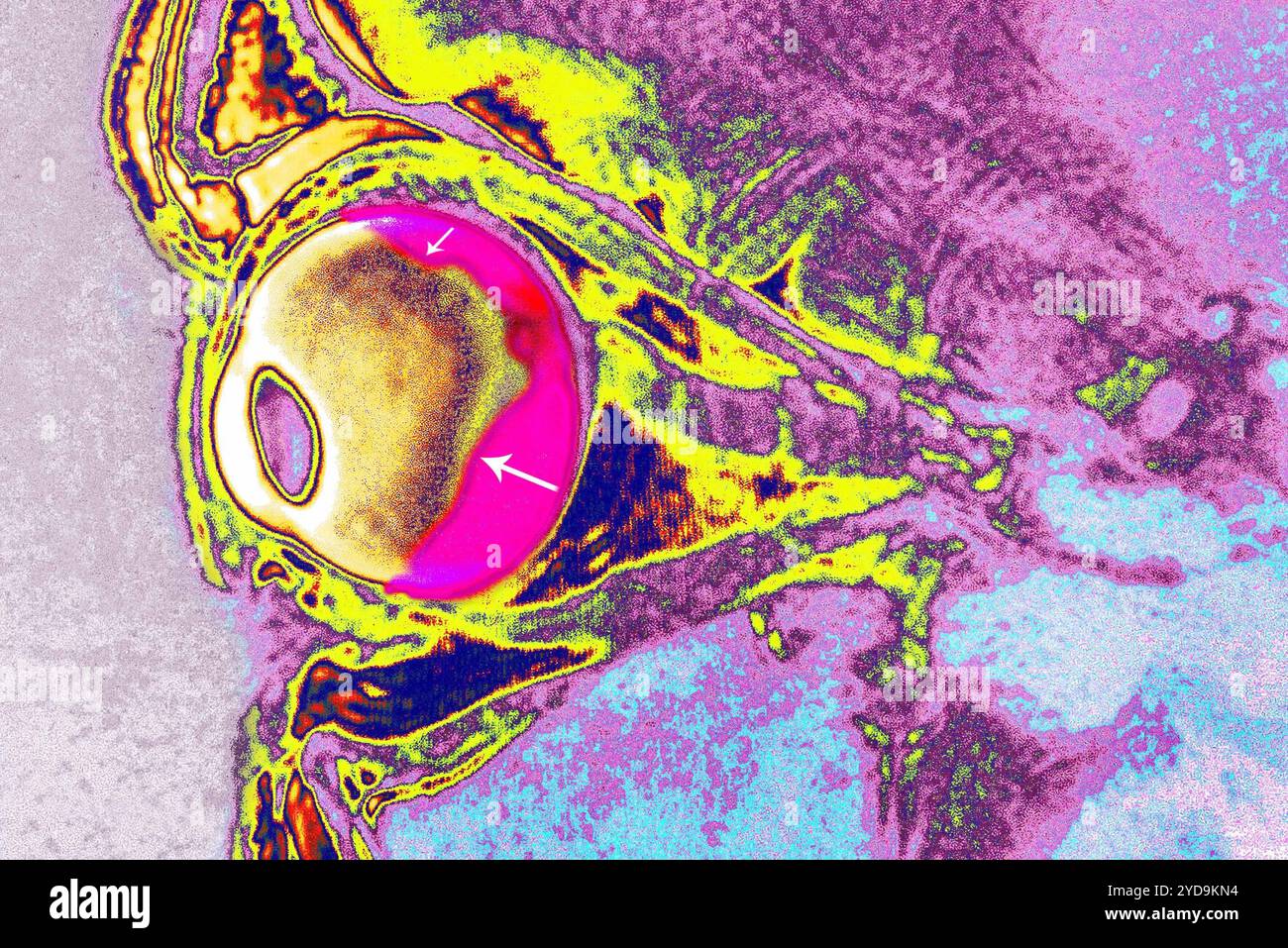 Retinal detachment occurs when the tissue at the back of the eye ...