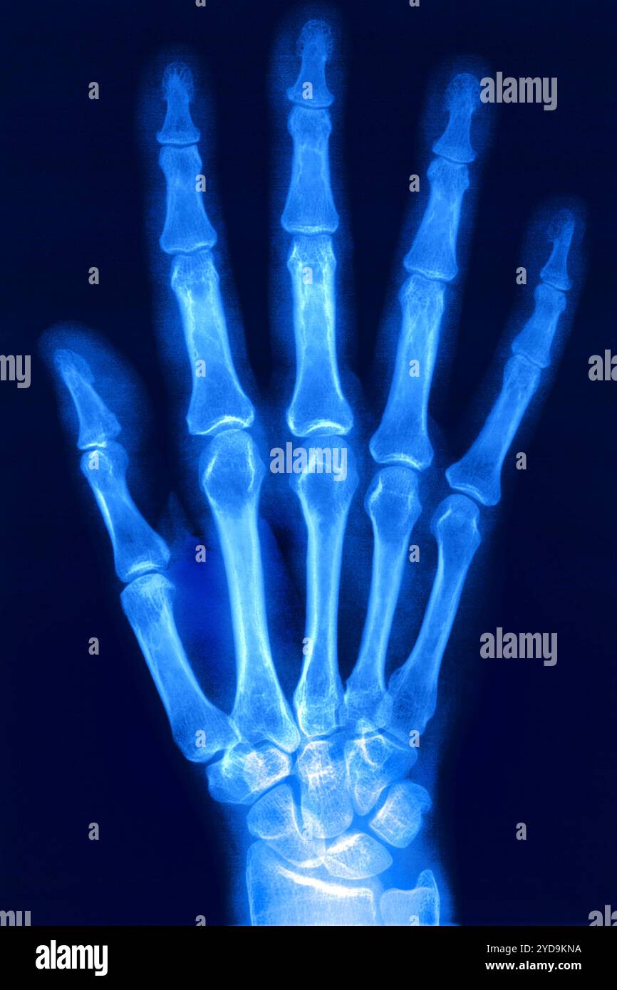 X-ray of a normal hand. X-ray of a hand. 016836 028 Stock Photo - Alamy