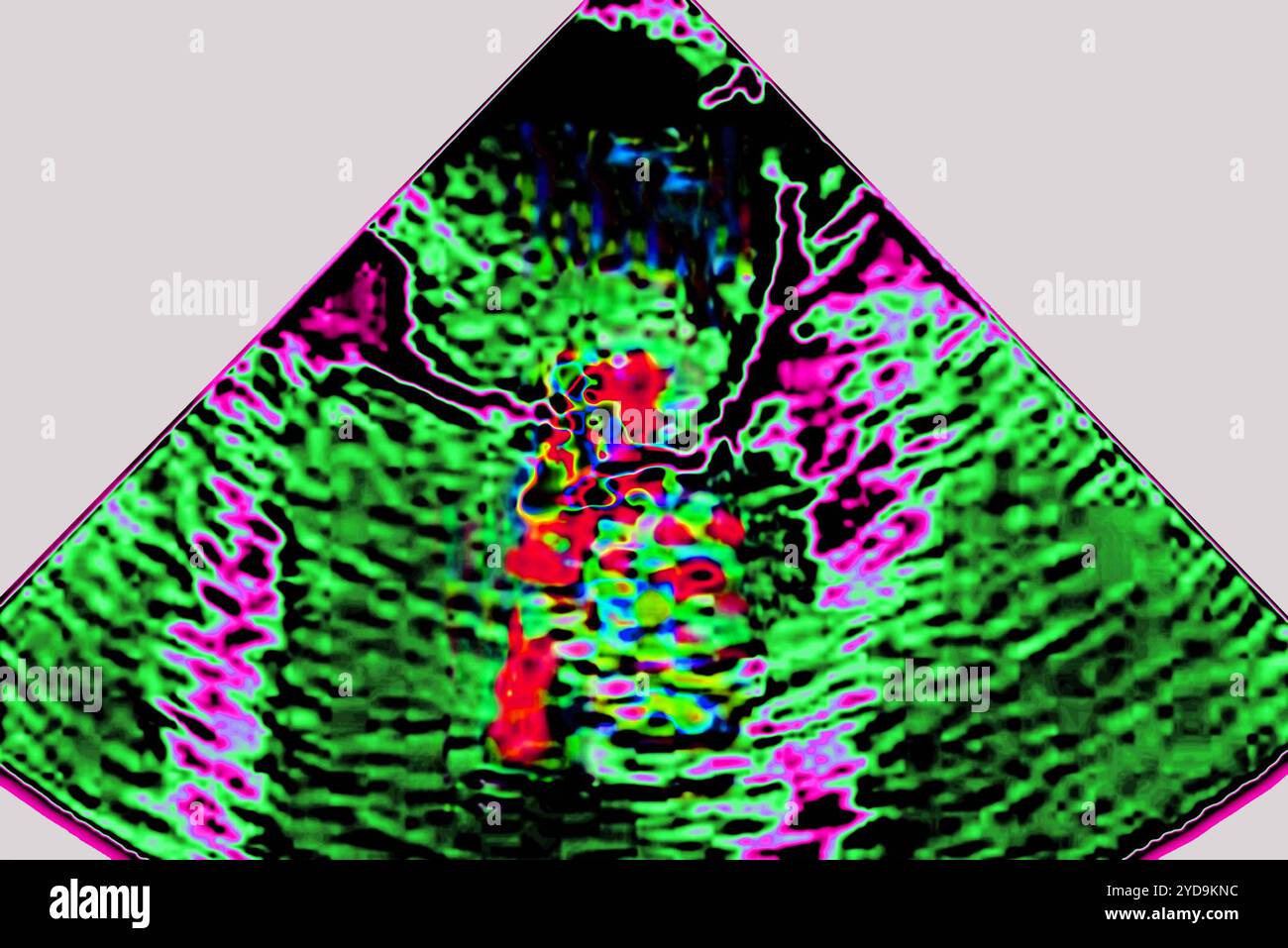 Ischemic mitral insufficiency MI - Pathology of the left ventricle ...