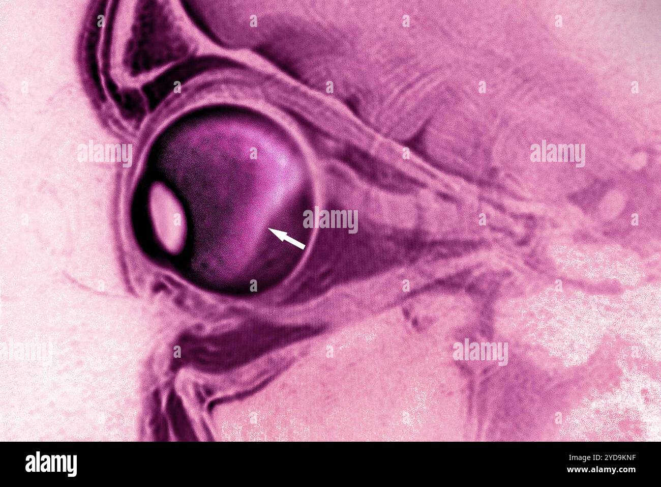 Retinal detachment occurs when the tissue at the back of the eye ...