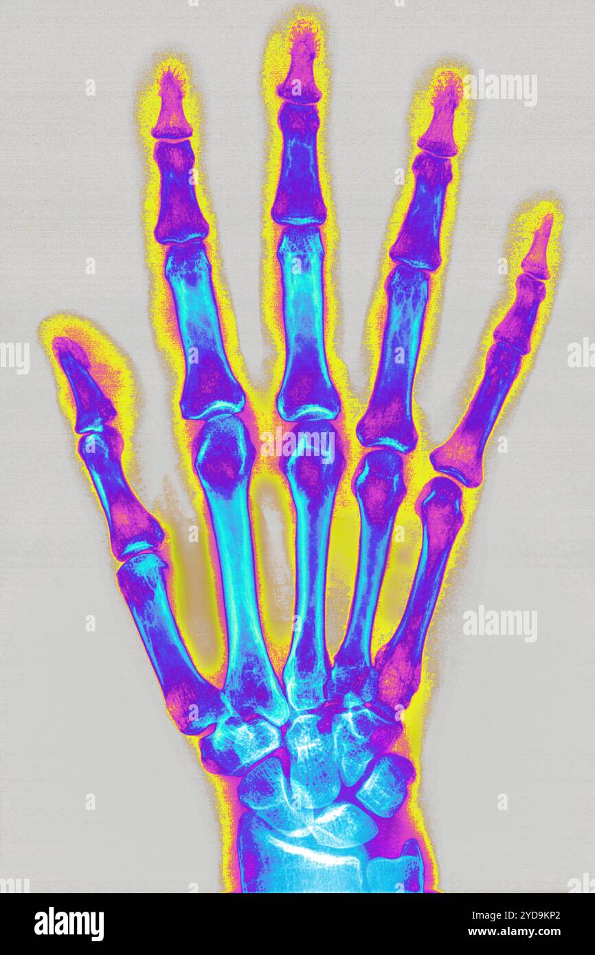 X-ray of a normal hand. X-ray of a hand. 016836 030 Stock Photo - Alamy