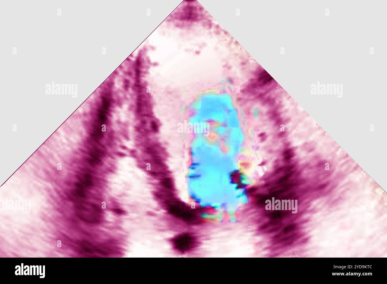 Ischemic mitral insufficiency MI - Pathology of the left ventricle ...
