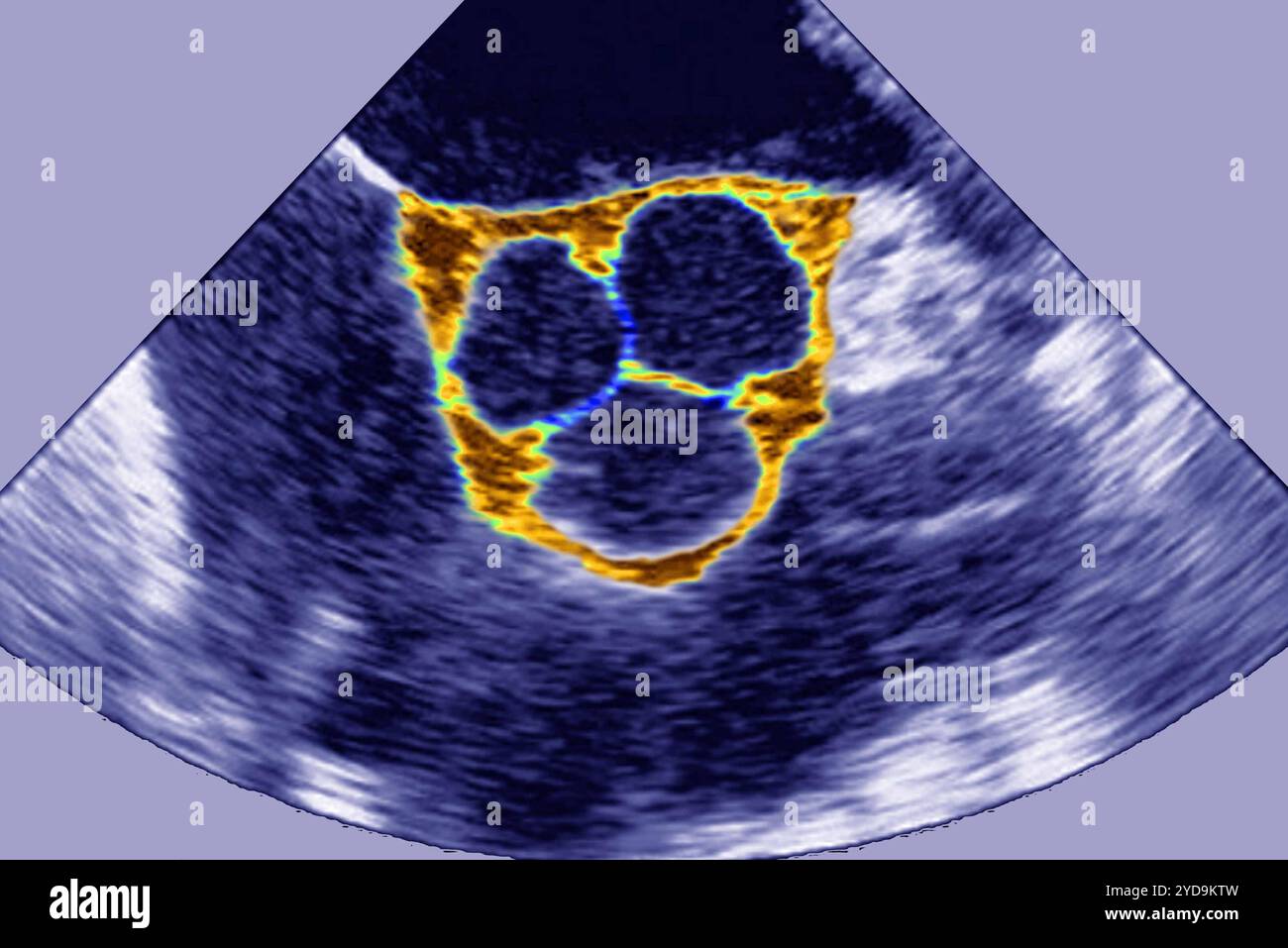 Atrioventricular valve hi-res stock photography and images - Alamy