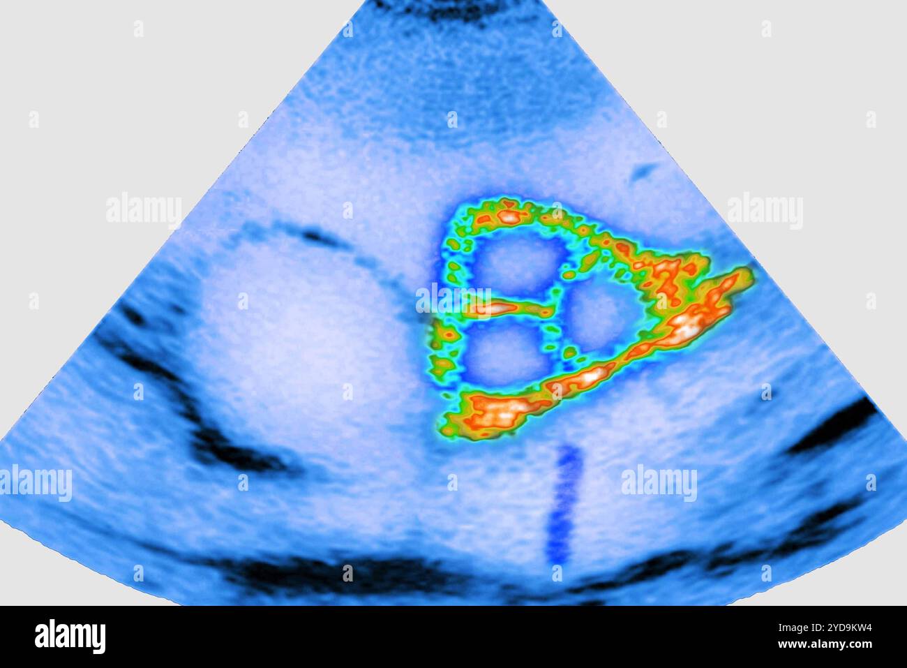 Tricuspid valve, it separates the right atrium and ventricle. It is ...
