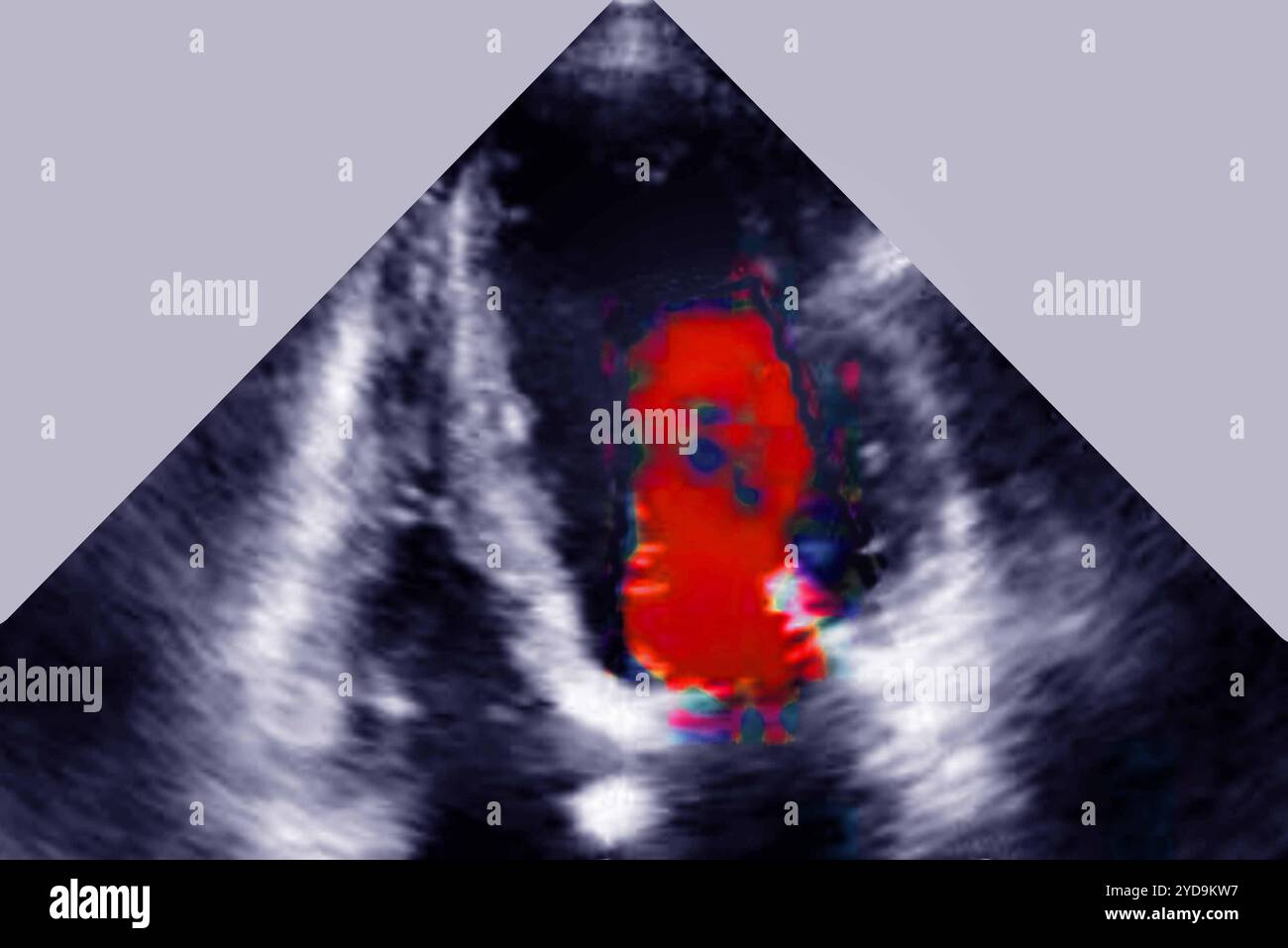 Ischemic mitral insufficiency MI - Pathology of the left ventricle ...