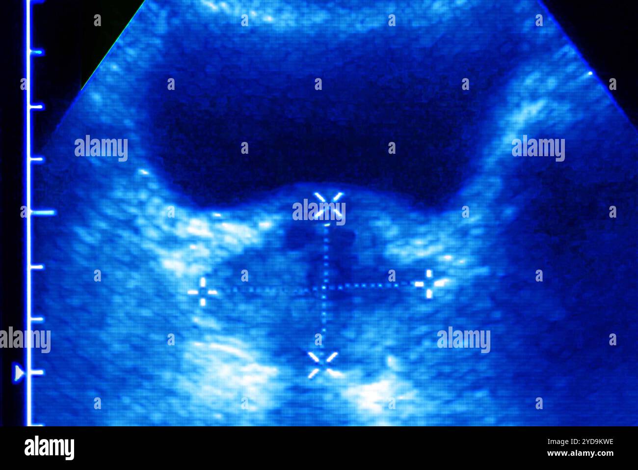 Prostate and bladder control examination with measurements of the ...