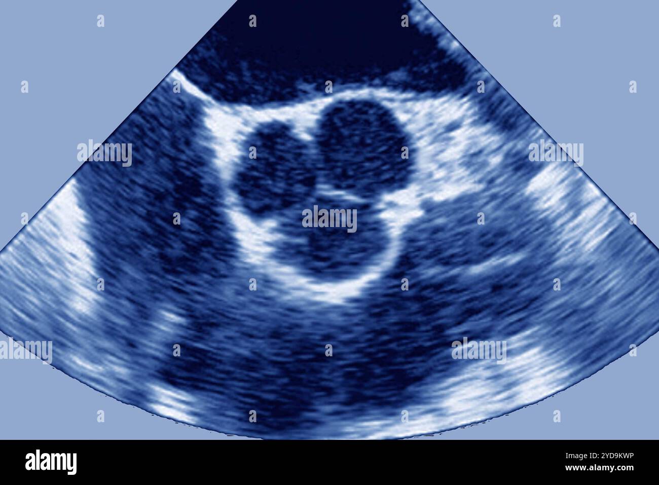 Tricuspid valve, it separates the right atrium and ventricle. It is ...