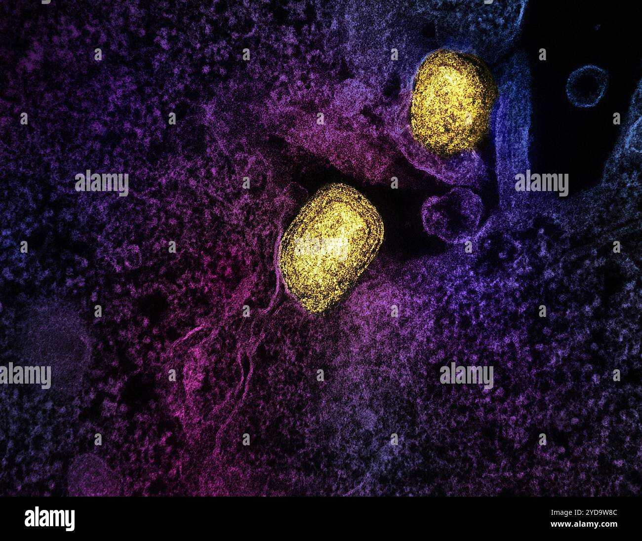 Colorized transmission electron micrograph of two mature mpox virus ...