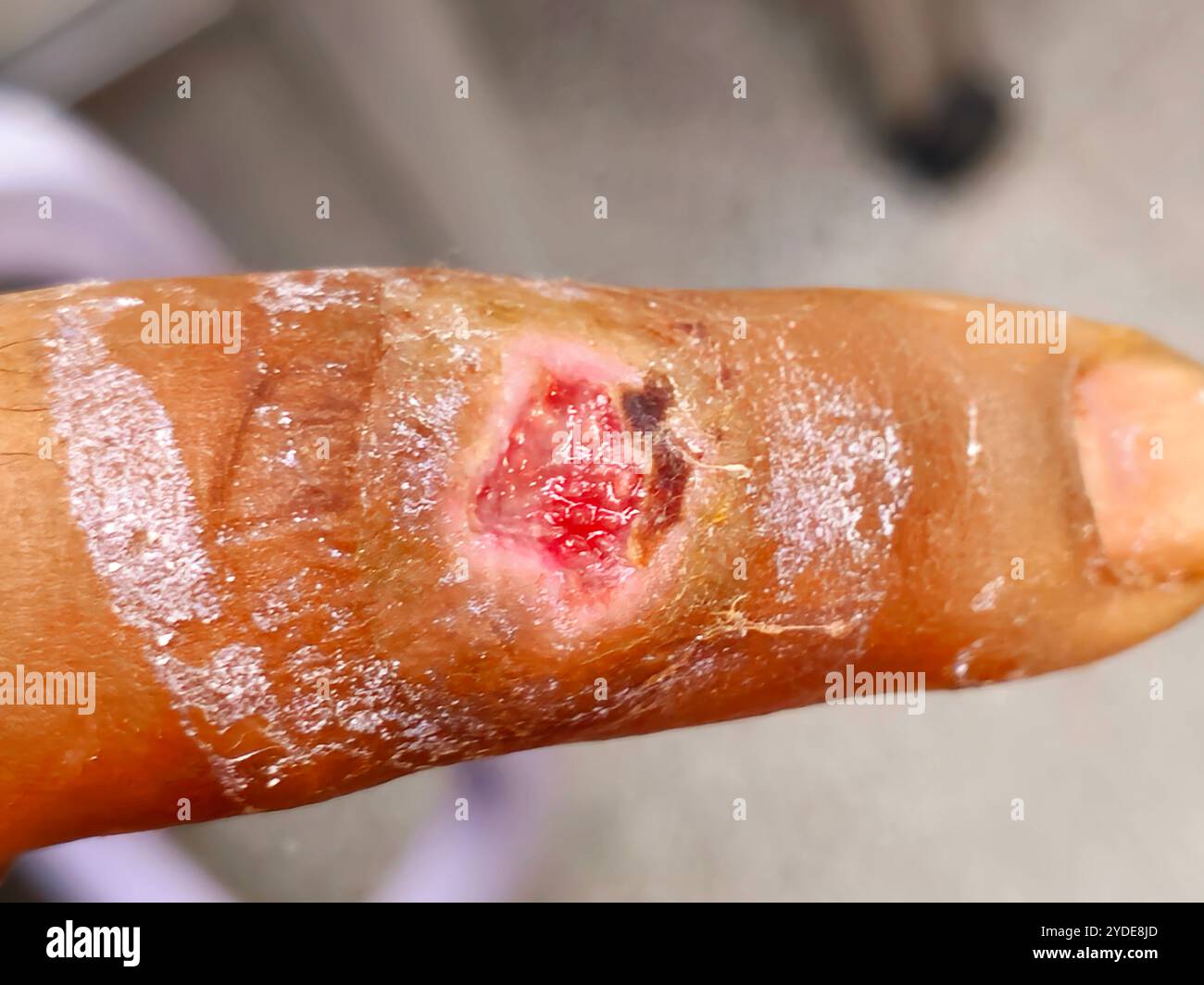 an abscess that was drained from pus and cleaned surgically, for ...