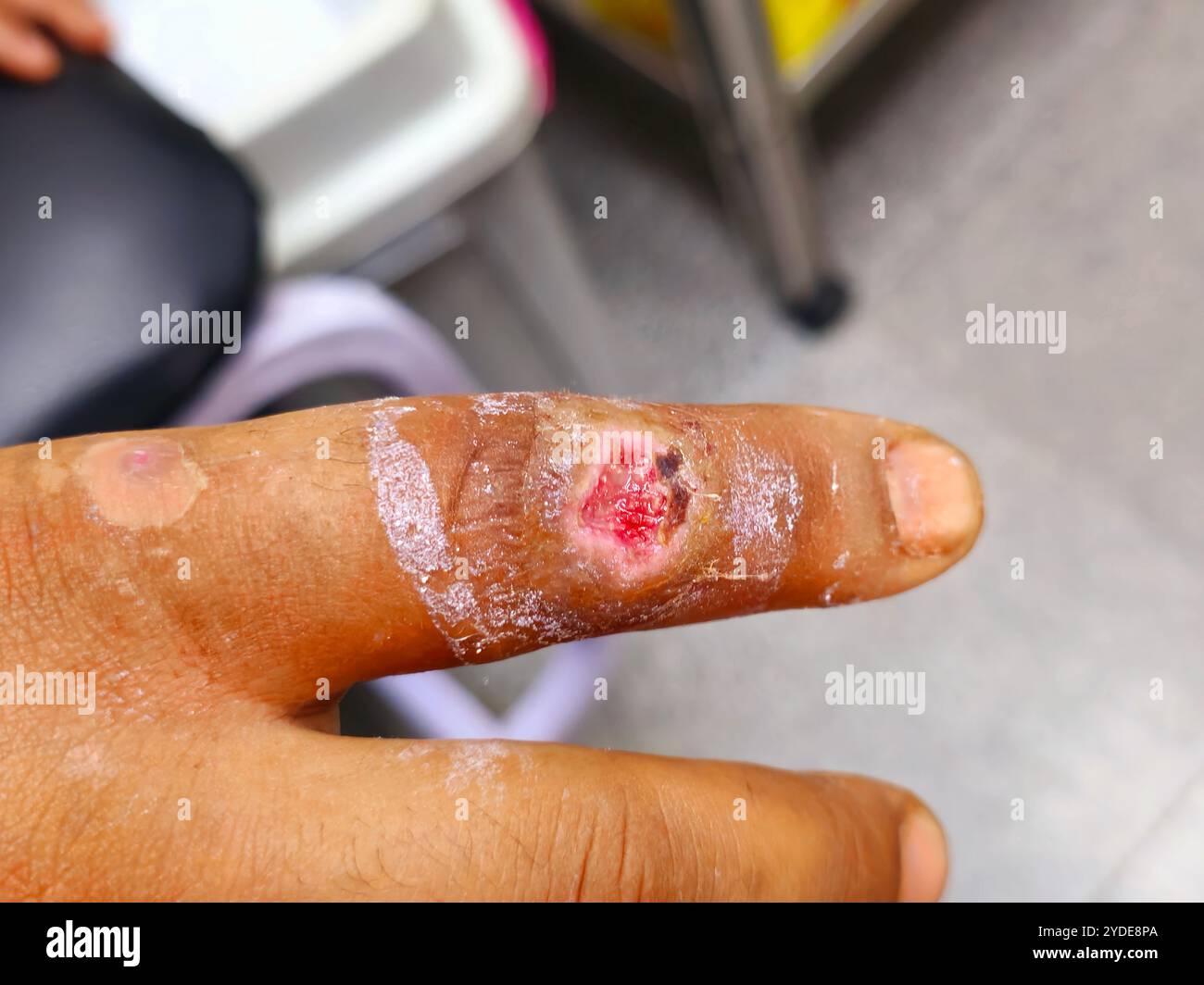 an abscess that was drained from pus and cleaned surgically, for ...