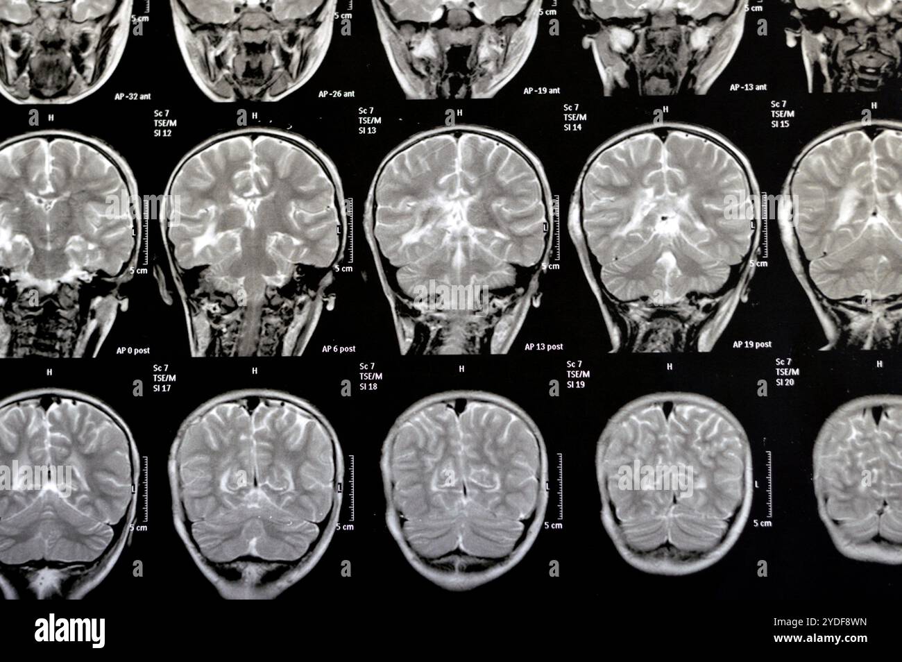 MRI of the brain reveals previous shunt operations for a hydrocephalus ...