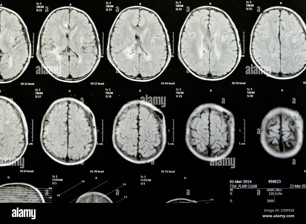 MRI of the brain reveals previous shunt operations for a hydrocephalus ...