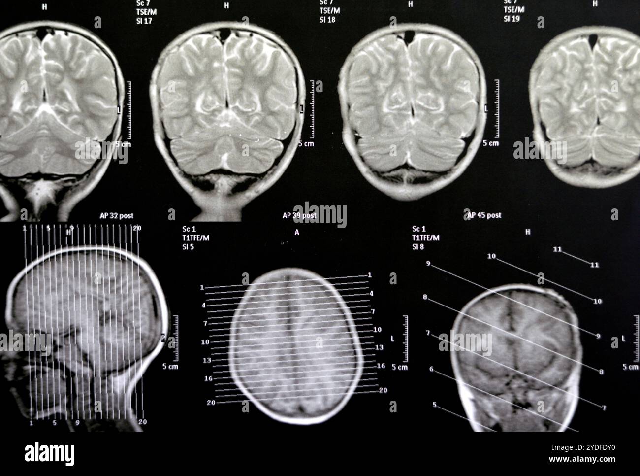 MRI of the brain reveals previous shunt operations for a hydrocephalus ...