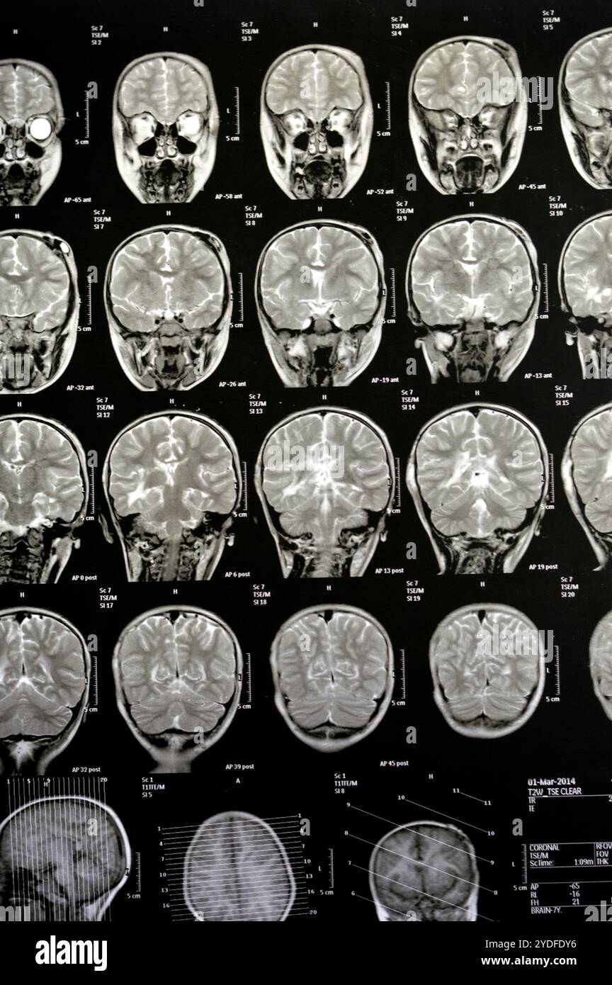 MRI of the brain reveals previous shunt operations for a hydrocephalus ...