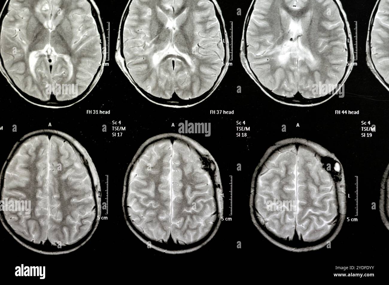 MRI of the brain reveals previous shunt operations for a hydrocephalus ...