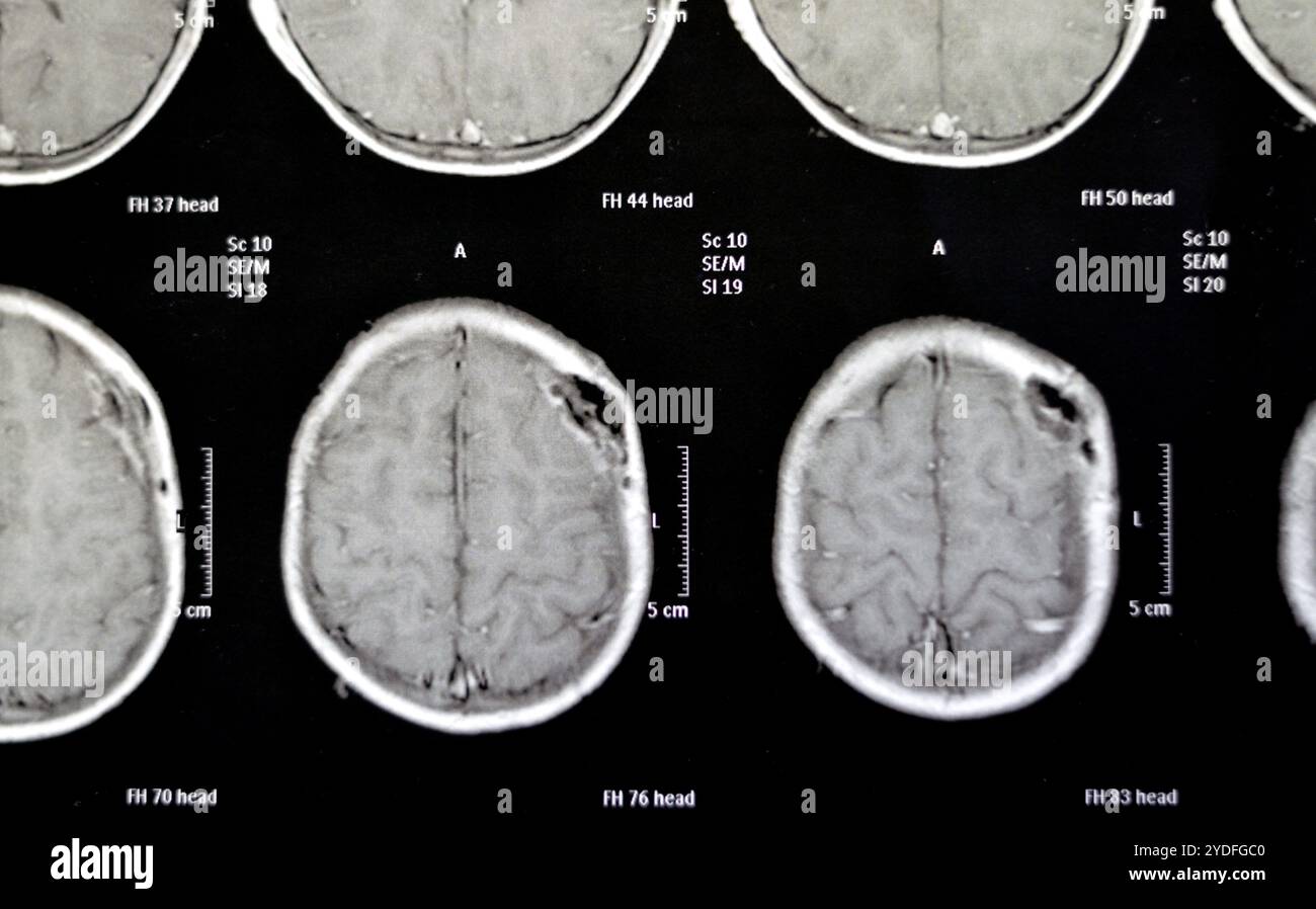 MRI of the brain reveals previous shunt operations for a hydrocephalus ...