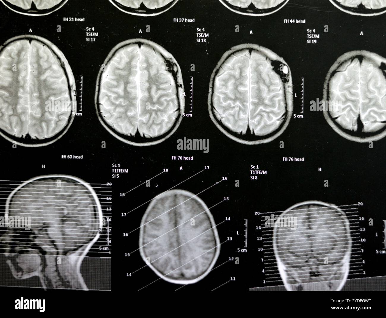 MRI of the brain reveals previous shunt operations for a hydrocephalus ...