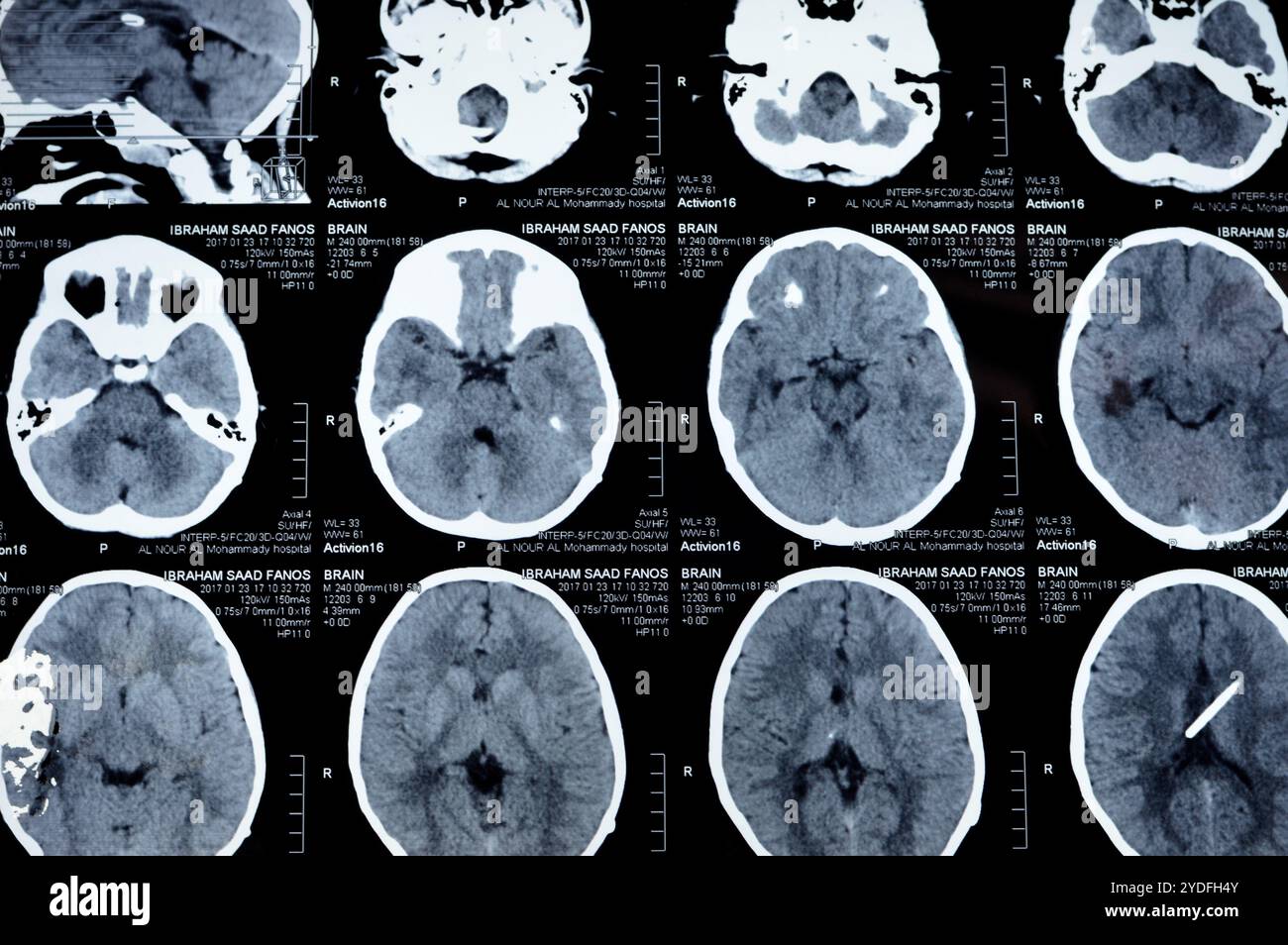 Cairo, Egypt, September 17 2024: Brain CT scan reveals left shunt tube ...