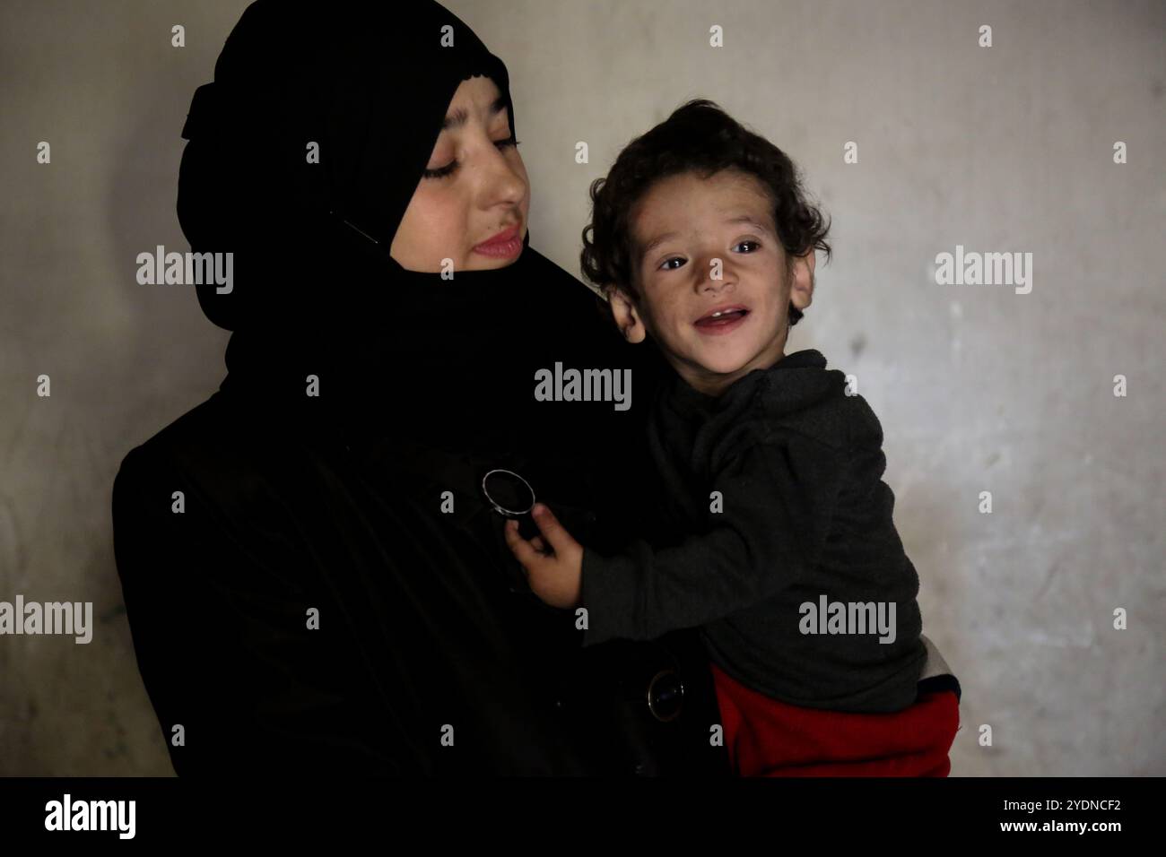 Severe acute malnutrition hi-res stock photography and images - Alamy