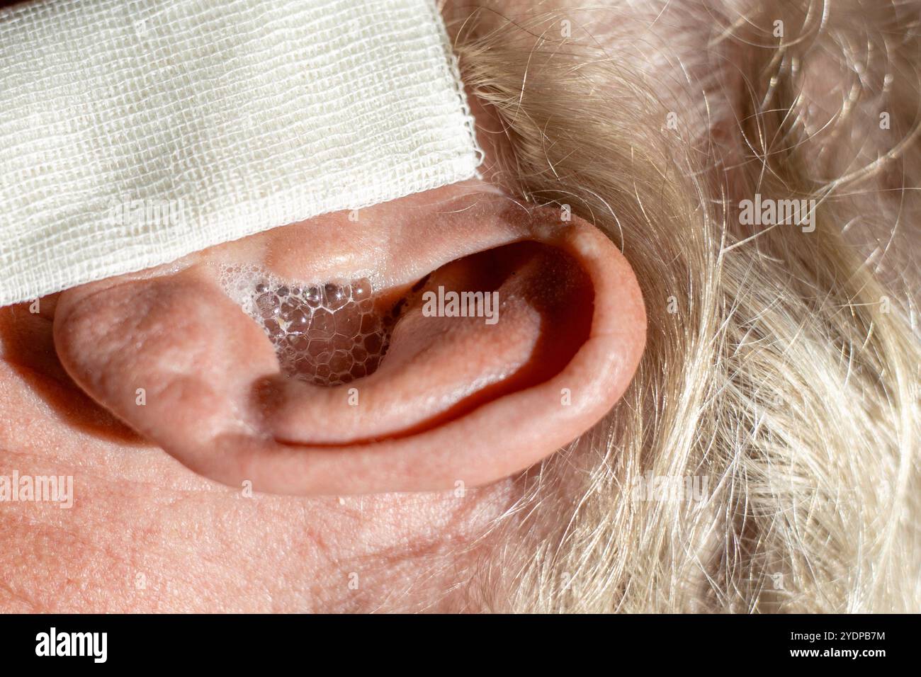 Ear diseases. Dropping hydrogen peroxide into a man's ears to soften ...