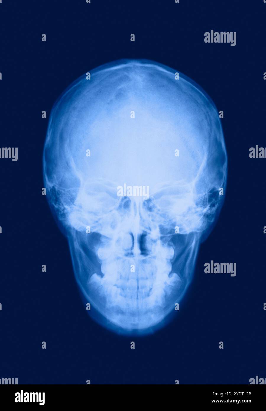 Radiograph of the brain Stock Photo - Alamy