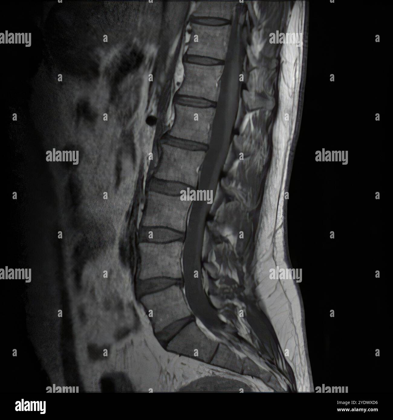 Sagittal mri scan of the lumbar spine showing healthy vertebrae and ...