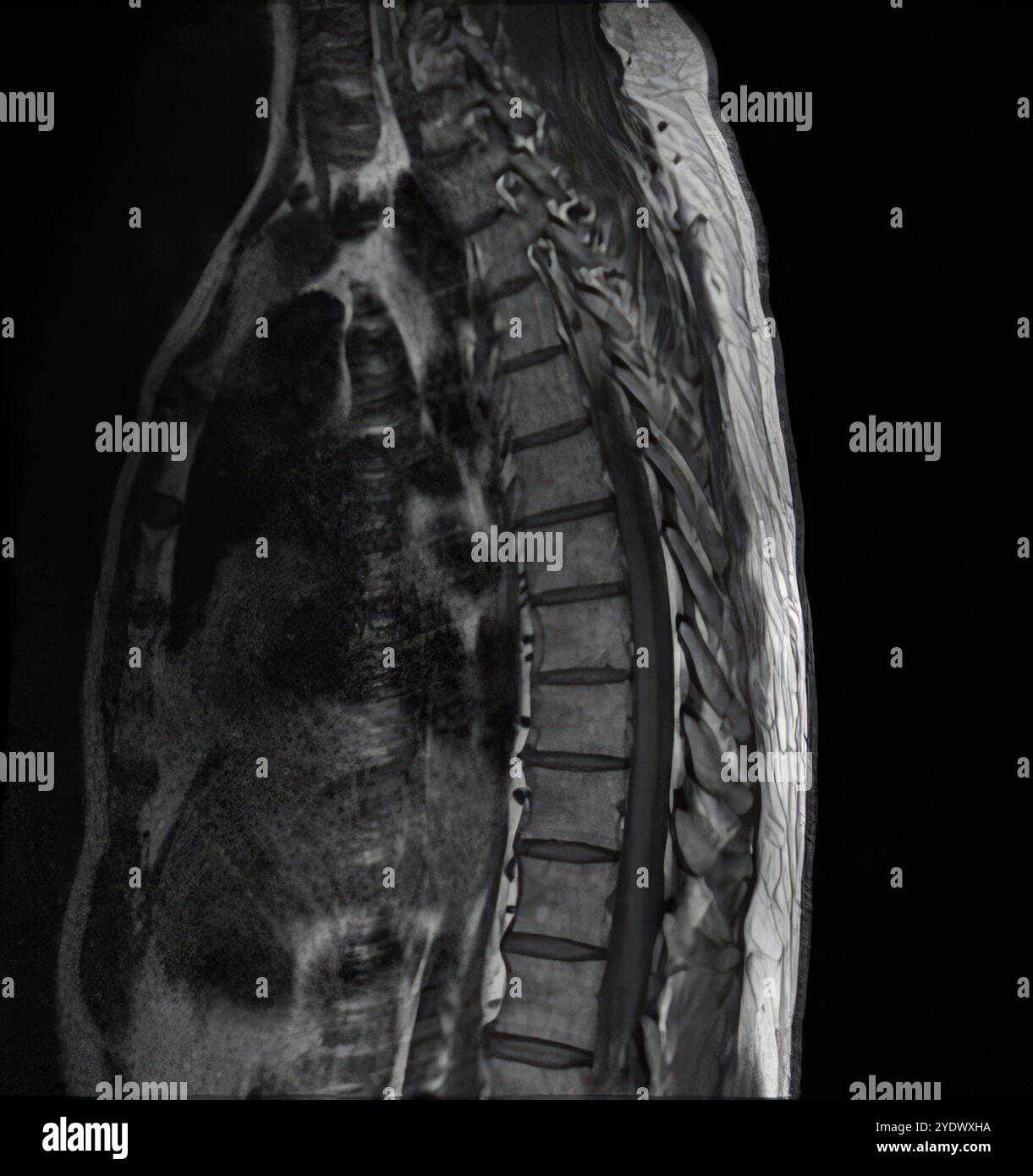Sagittal mri scan of thoracic and lumbar spine, showing healthy spinal cord, vertebrae ...
