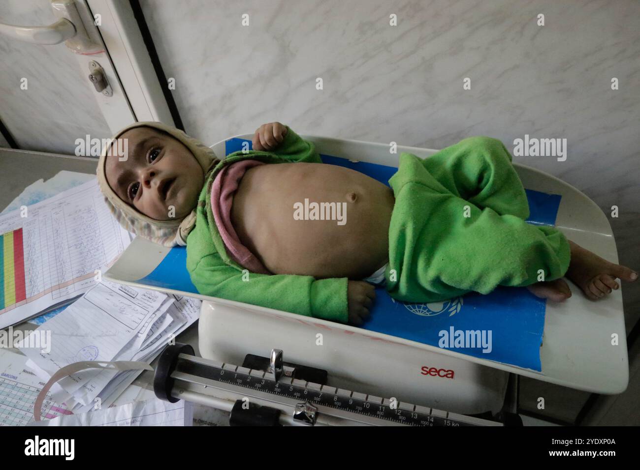 A child suffering from severe malnutrition receive treatment in a ...