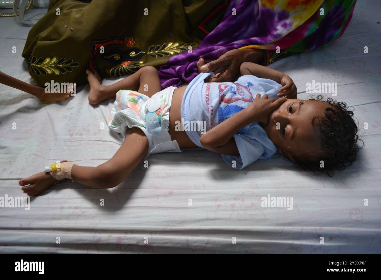 A child suffering from severe malnutrition receive treatment in a ...