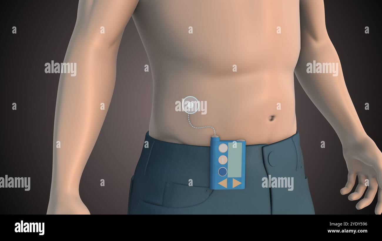 Blood Glucose Regulation Using Automated Insulin Pump Stock Photo - Alamy