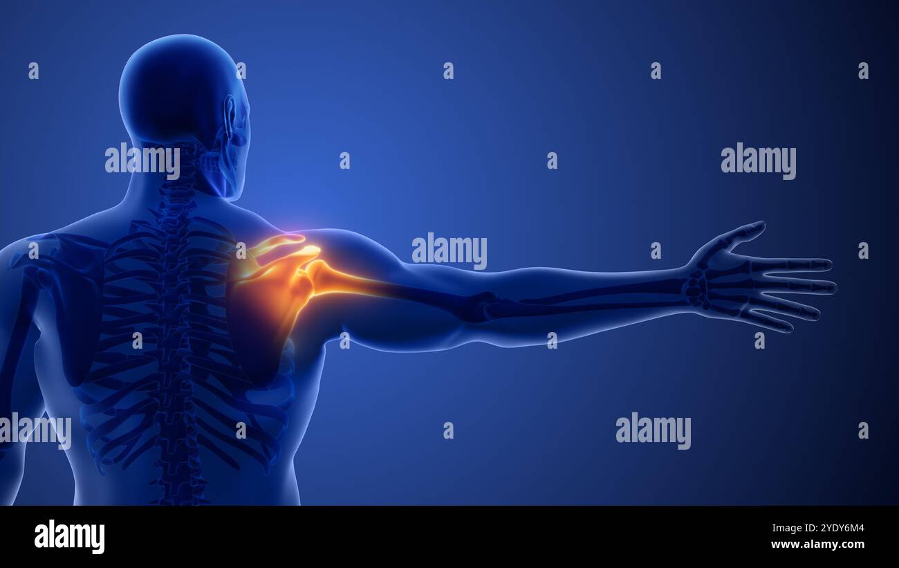 Bone disorders hi-res stock photography and images - Alamy