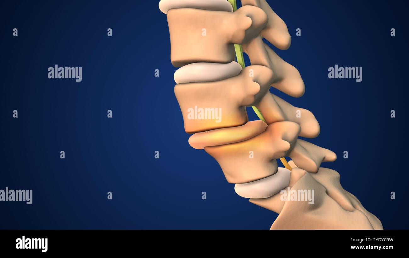 Spondylolisthesis hi-res stock photography and images - Alamy
