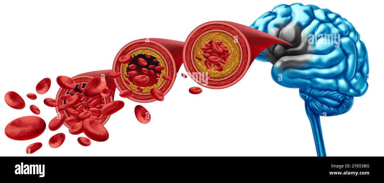 Neurological impairment Cut Out Stock Images & Pictures - Alamy