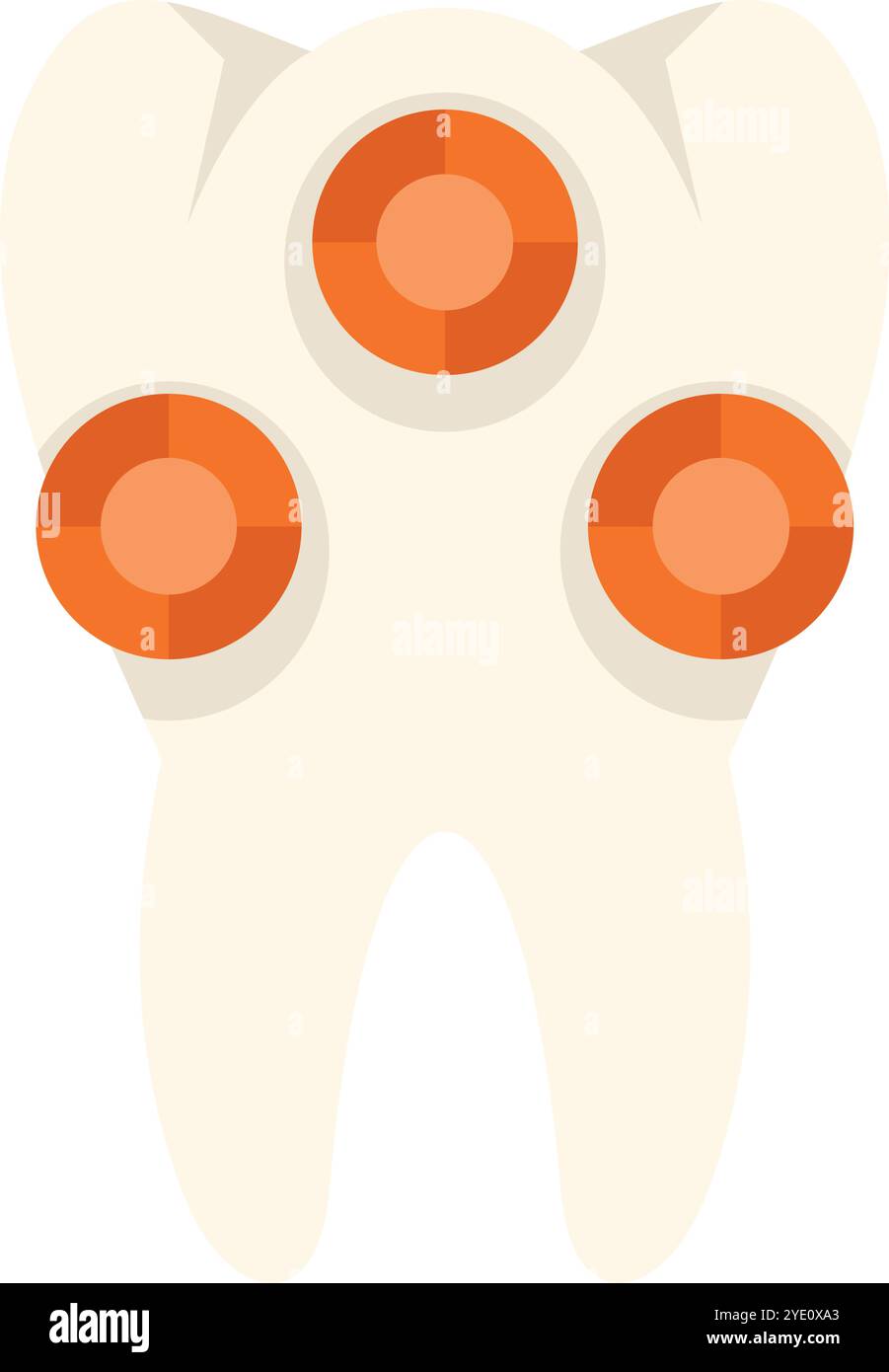 This illustration shows the progression of tooth decay and the damage ...