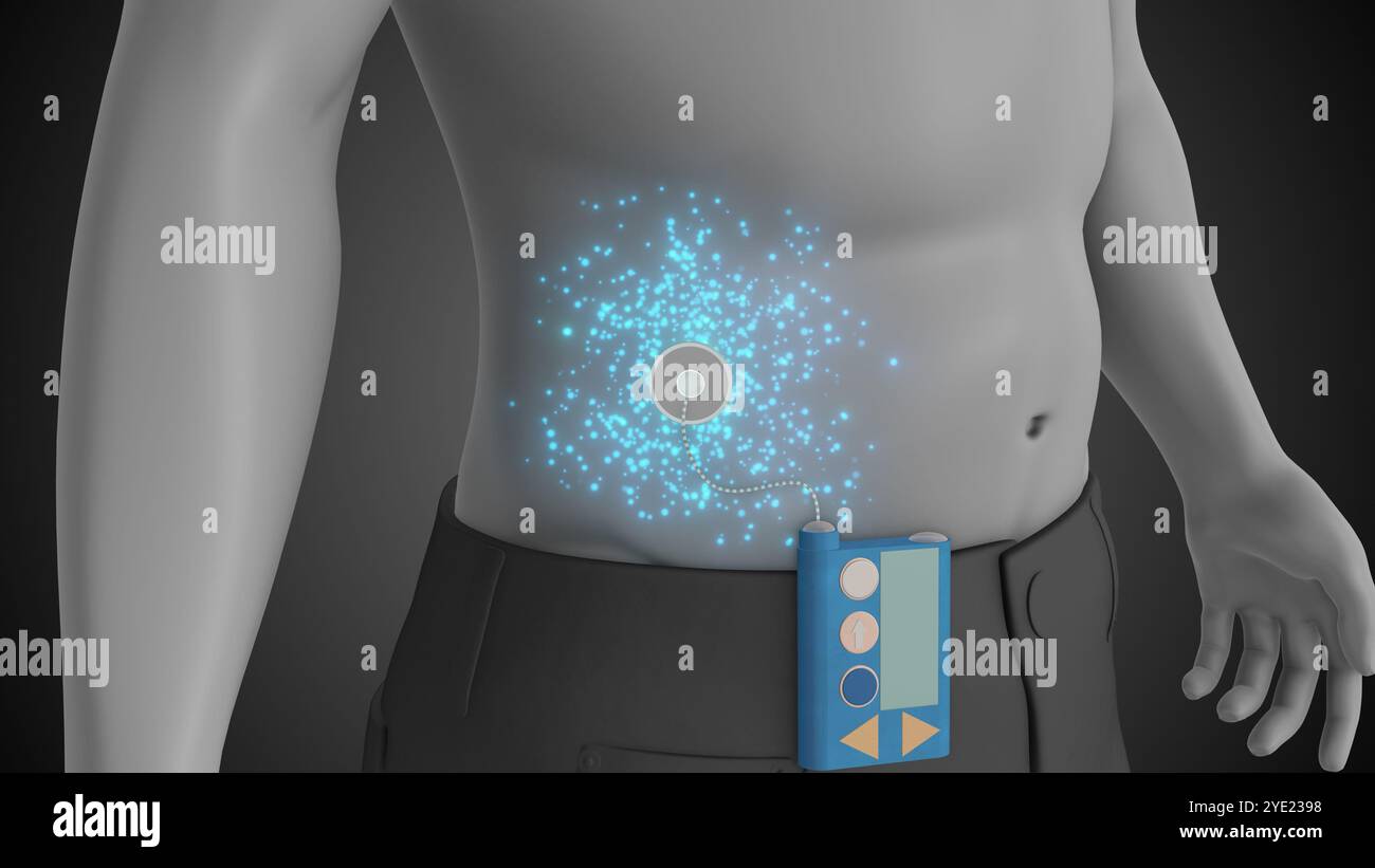 Insulin Pump Regulates Blood Glucose Levels Continuously Stock Photo ... Insulin Pump Regulates Blood Glucose Levels Continuously Stock Photo ...