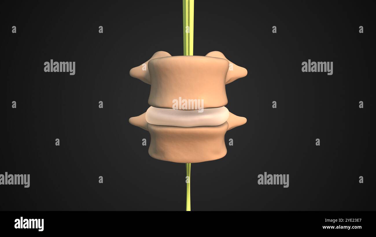 Vertebral Slippage Resulting in Spondylolisthesis Symptoms Stock Photo ...